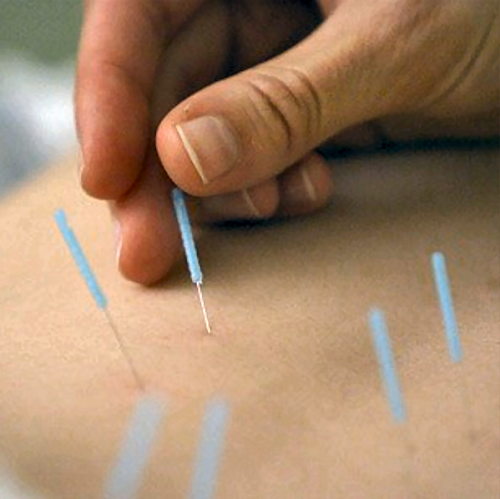 Acupuncture FAQ’s – Acupuncture & Herbcare